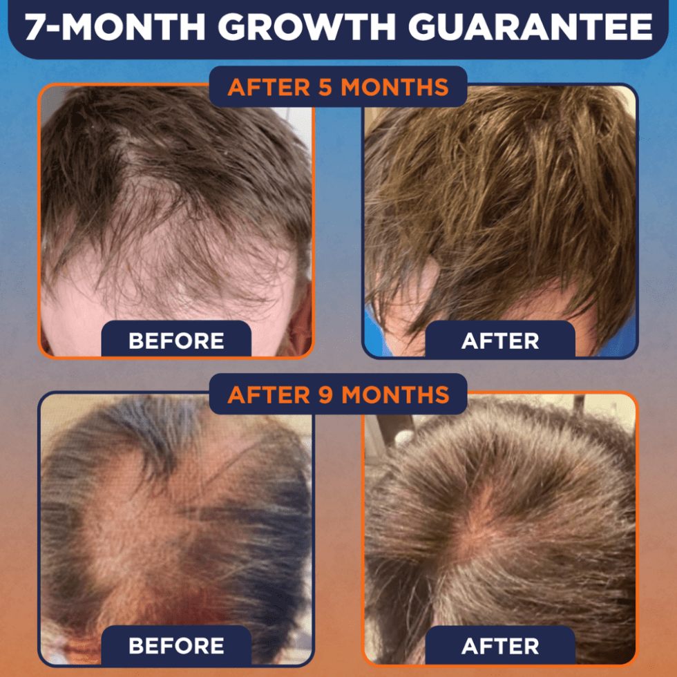 272 Premier Laser Hair Cap - MAX Growth Bundle(2-4 Month Supply)