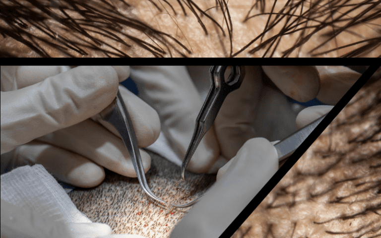 What Is A Trichologist? - Kiierr Laser Hair Caps - Hair Growth Experts