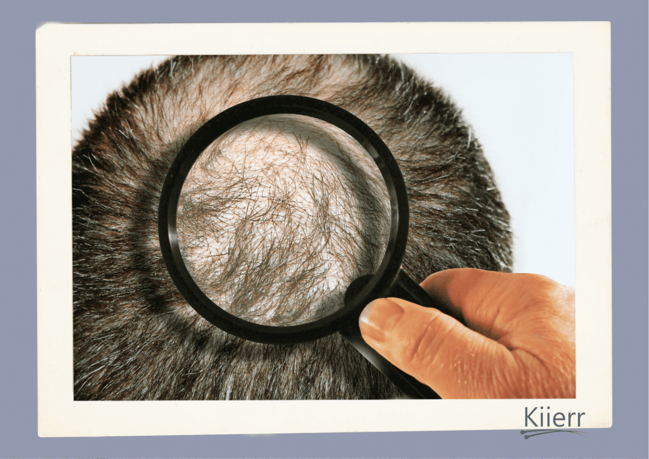 What Can Cause Sudden and Rapid Onset of Hair Loss? - Kiierr Laser Hair ...